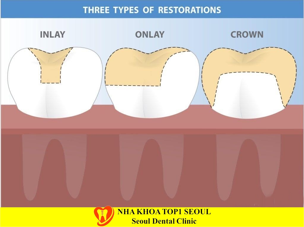 INLAY và ONLAY LÀ GÌ?